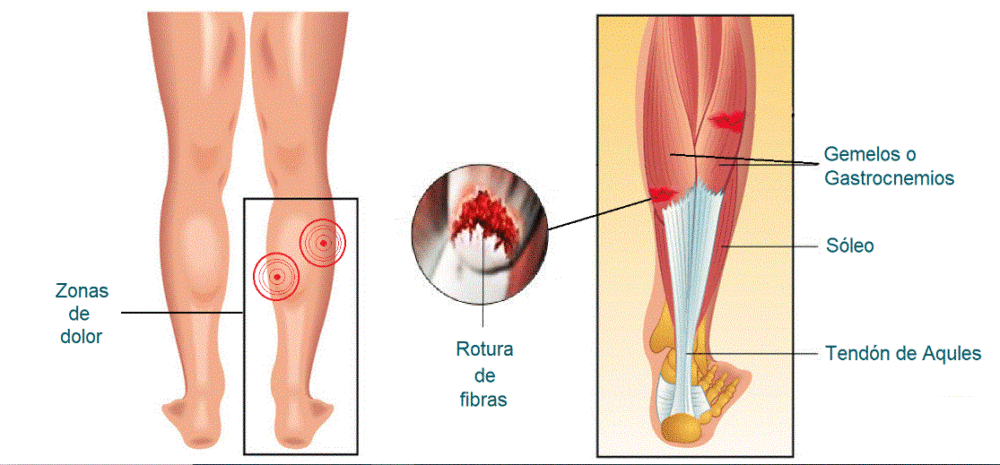 Gastrocnemio: Funciones y ejercicios del gemelo